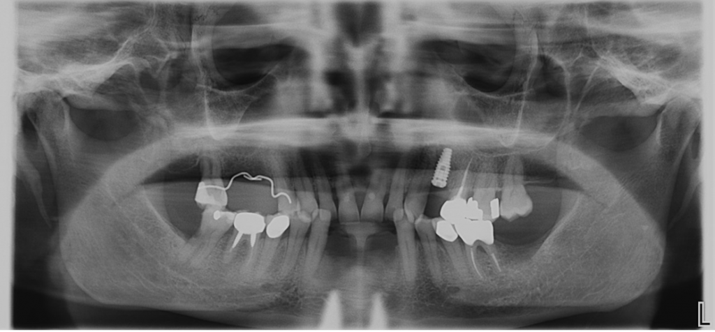 Socket Augmentation - Shefa Bone