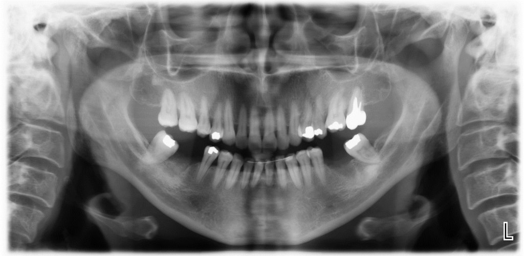 Socket Augmentation - Shefa Bone