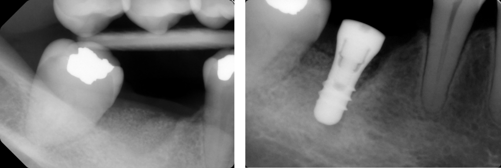 Socket Augmentation - Shefa Bone