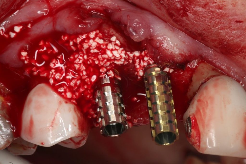 Socket Augmentation - Shefa Bone