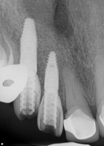 Socket Augmentation - Shefa Bone