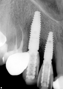 Socket Augmentation - Shefa Bone