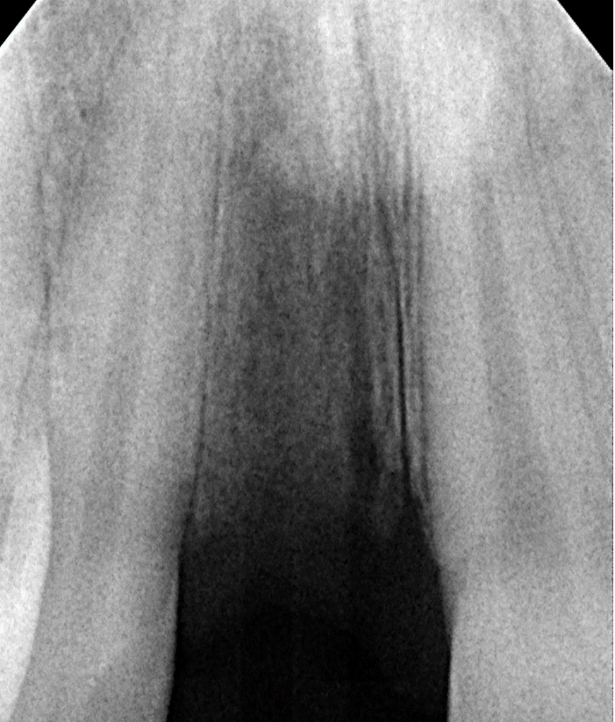 Socket Augmentation - Shefa Bone