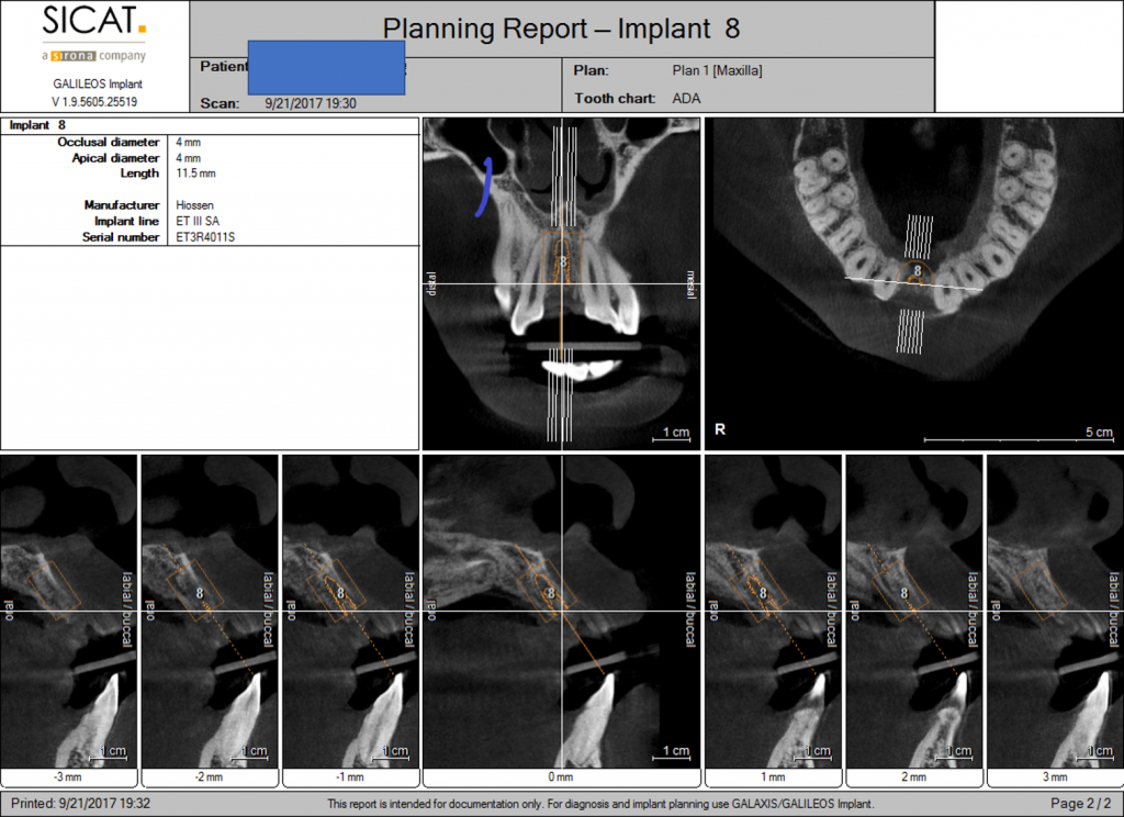 Socket Augmentation - Shefa Bone