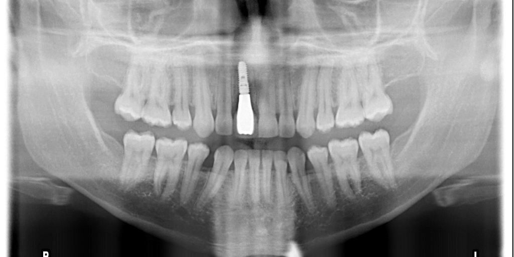 Socket Augmentation - Shefa Bone
