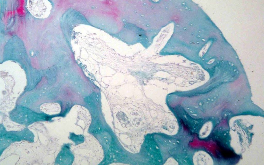 Socket Augmentation - Shefa Bone