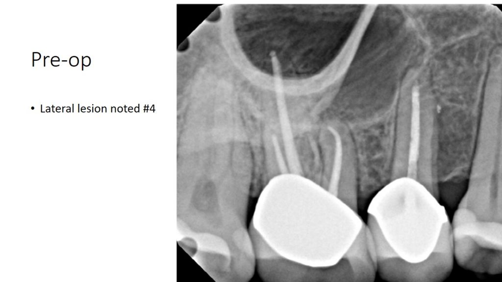 Endo Case 1 Slide2 - Shefa Bone