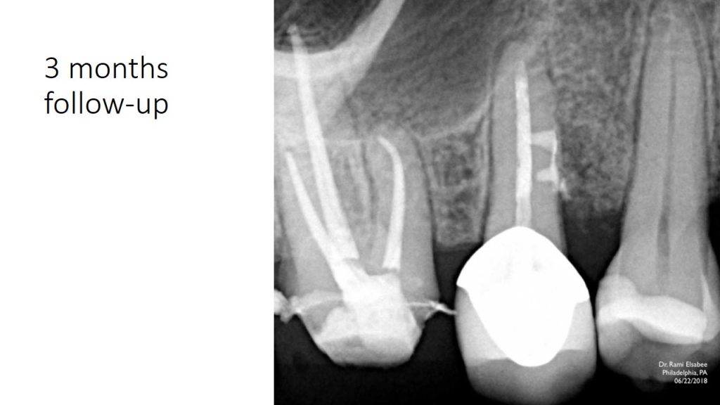 Endo Case 1 Slide6 - Shefa Bone